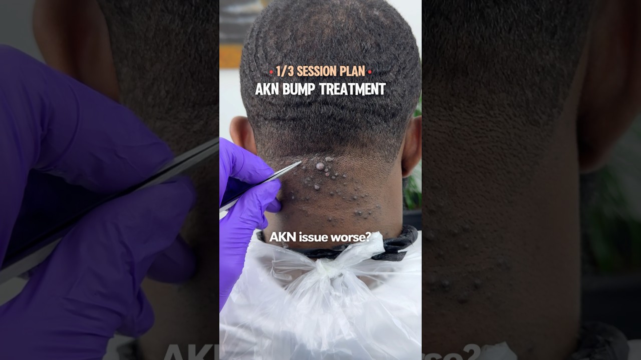 AKN Treatment! #bumptreatment #ingrownhair #ingrownhairremoval #ingrownhairextraction #akn #barber