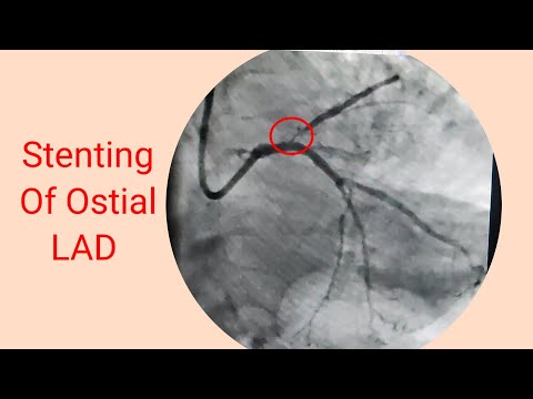 Heart attack (AWMI) lI Stenting of Ostial LAD