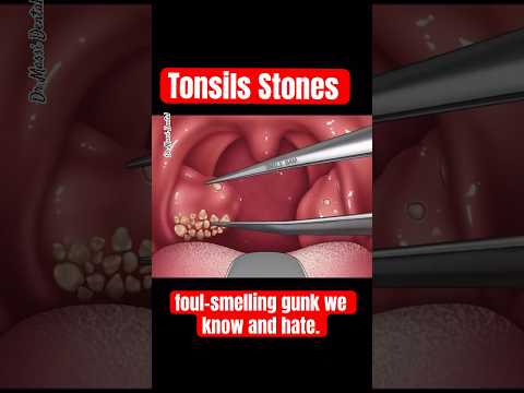 TONSILS STONES, TONSILLITIS