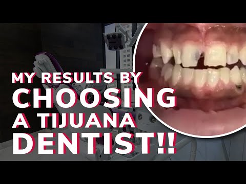 😱 MY HONEST OPINION COMING FOR VENEERS IN TIJUANA MEXICO 🤔 [XDentistry Reviews]
