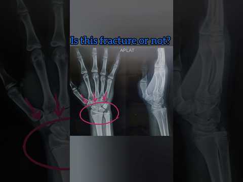 Is this fracture or not? #medicalimaging #xray #radiology