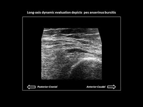 Pes anserinus bursitis on knee ultrasound