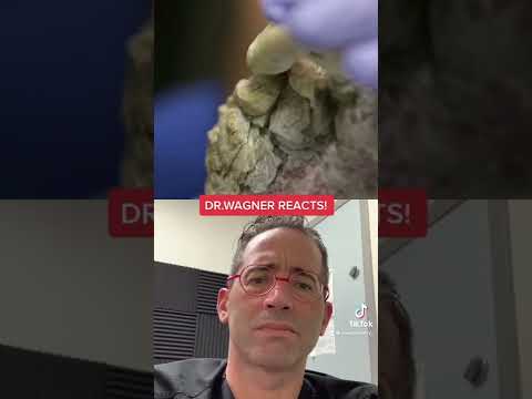 BIGGEST THICKEST TOENAILS? ???? #shorts #toenail #fungus
