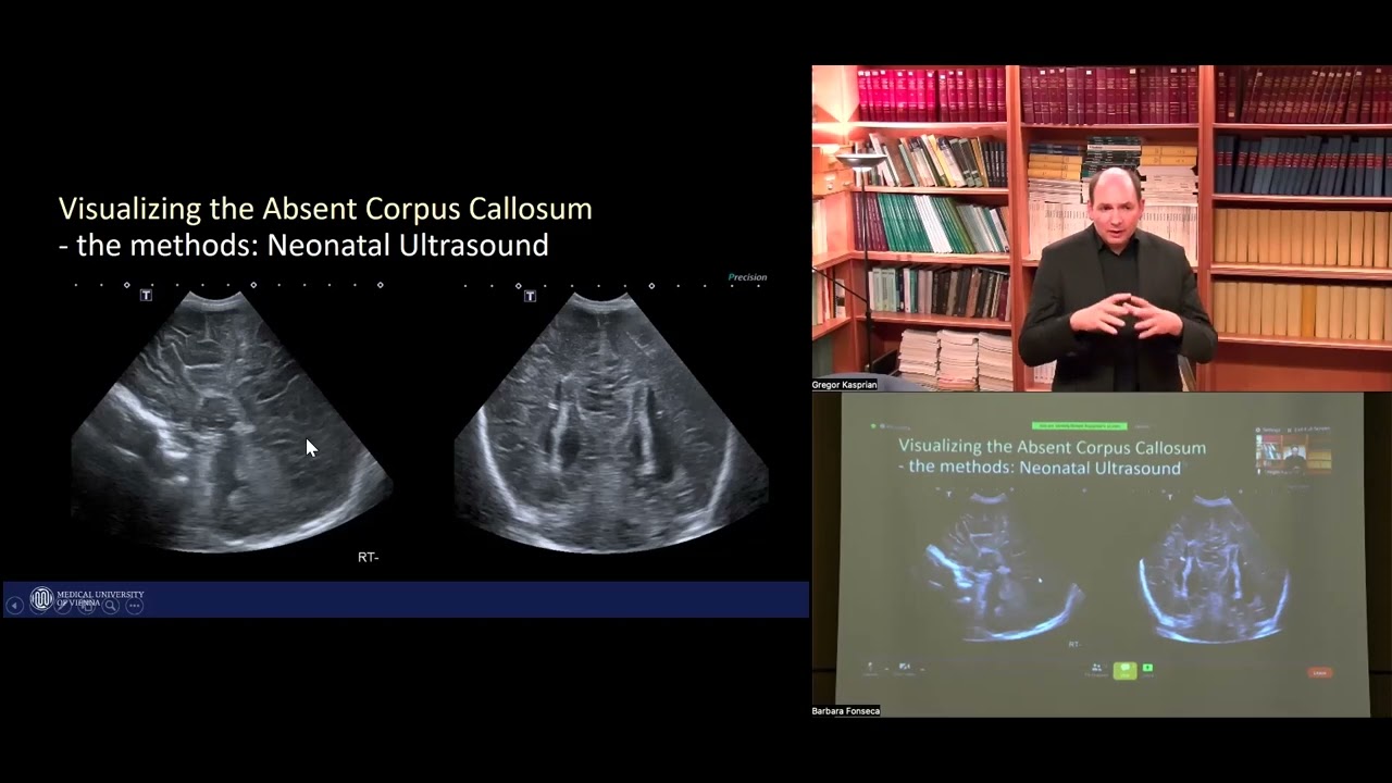 MRI Diagnosis of CCD and Associated Brain Anomalies, Linda J. Richards PhD, Gregor Kasprian MD, PhD