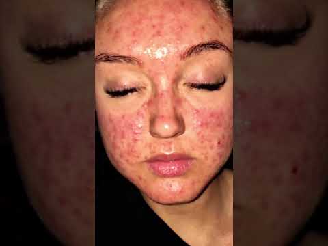 1 product that changed my life ????????❤️ #shorts #acne #skincare