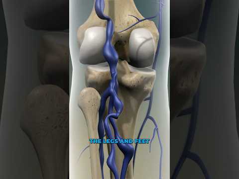 What causes varicose veins? (3D Animation)