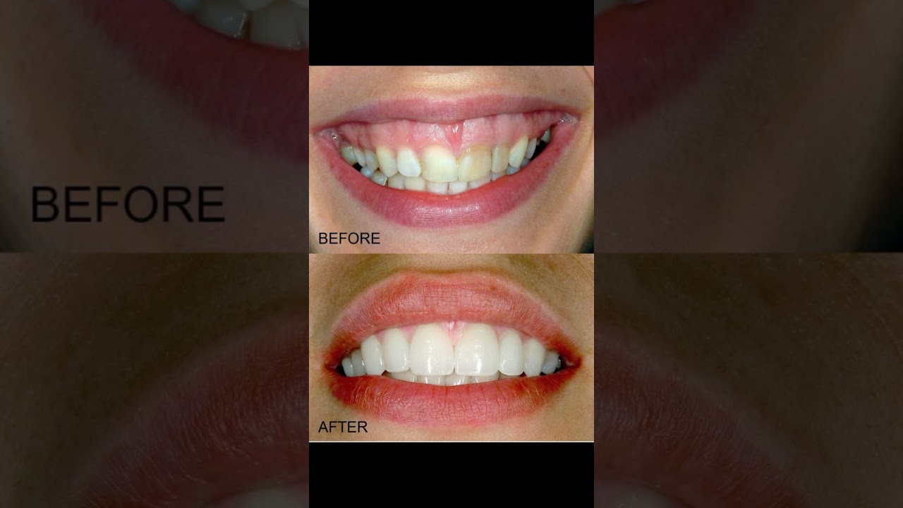 What Is A Gummy Smile, and How Can I Fix It?