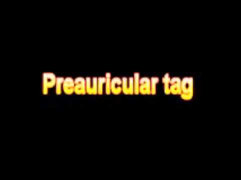 What Is The Definition Of Preauricular tag Medical School Terminology Dictionary