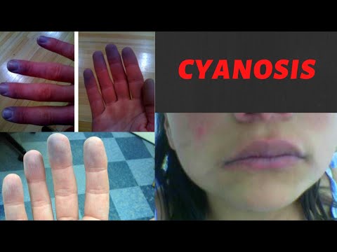 CYANOSIS : Causes, Symptoms, Types, Treatment I What is cyanosis? Peripheral and Central Cyanosis