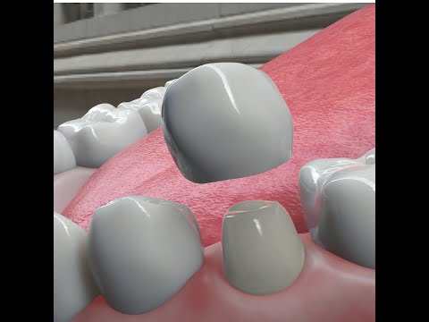 Dental Crowns: What They Are & Why We Need Them