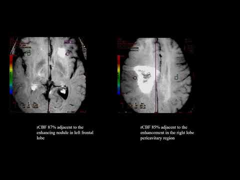 CAR - Case of the week - Case 7 - Radiation Necrosis and BT - RADS