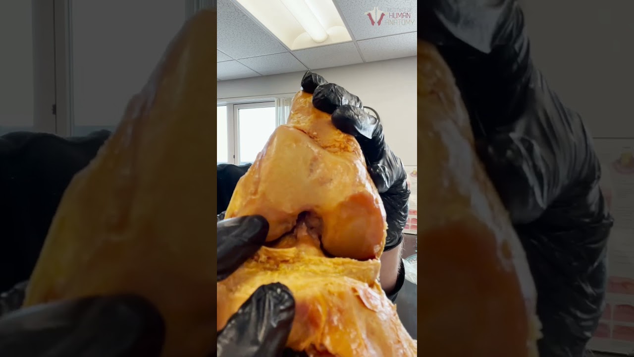 Inside a Real Knee With Worn Out Cartilage! | #shorts #kneepain