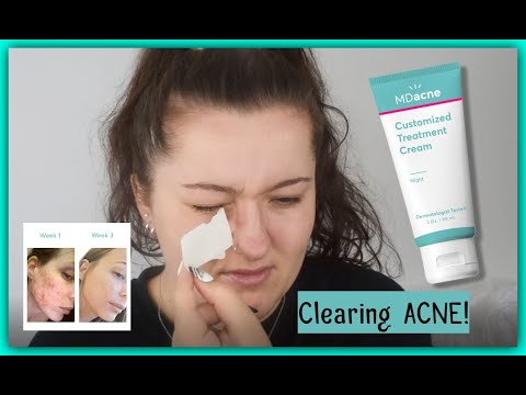 How to get rid of your acne -THE NEW WAY!