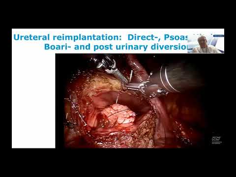 UROWebinar: Advanced robotic ureteral reconstruction