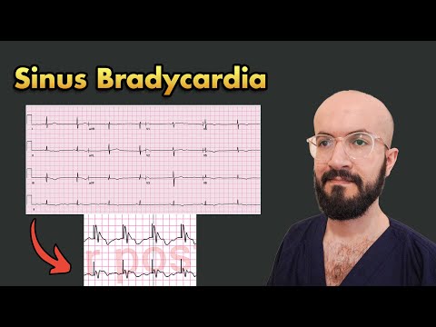 Sinus Bradycardia: EKG Characteristics, Causes and Treatment