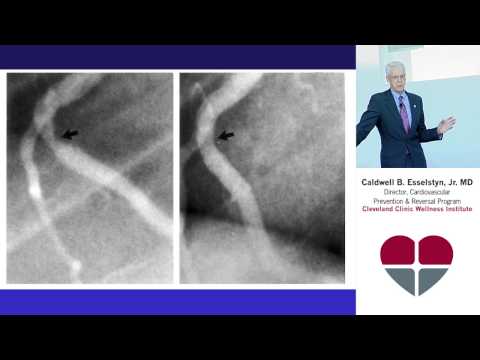 Caldwell B. Esselstyn, Jr. MD, Treating the Cause to Prevent and Reverse Heart Disease