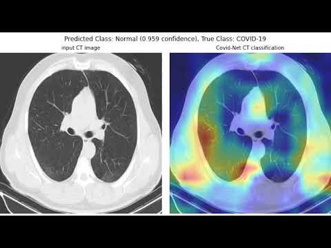 COVID-19 detection | Covid Net | CT with images | chest CT dataset