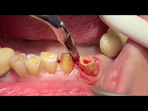 Infected and Broken Canine - Extraction Graft and Implants - Michael Katzap DDS