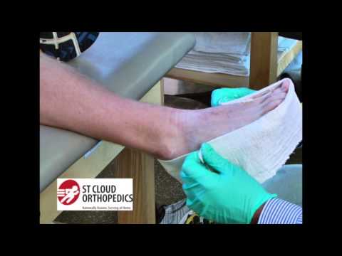 St. Cloud Orthopedics - Casting for Orthotics