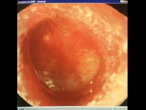 Acute Otitis Media
