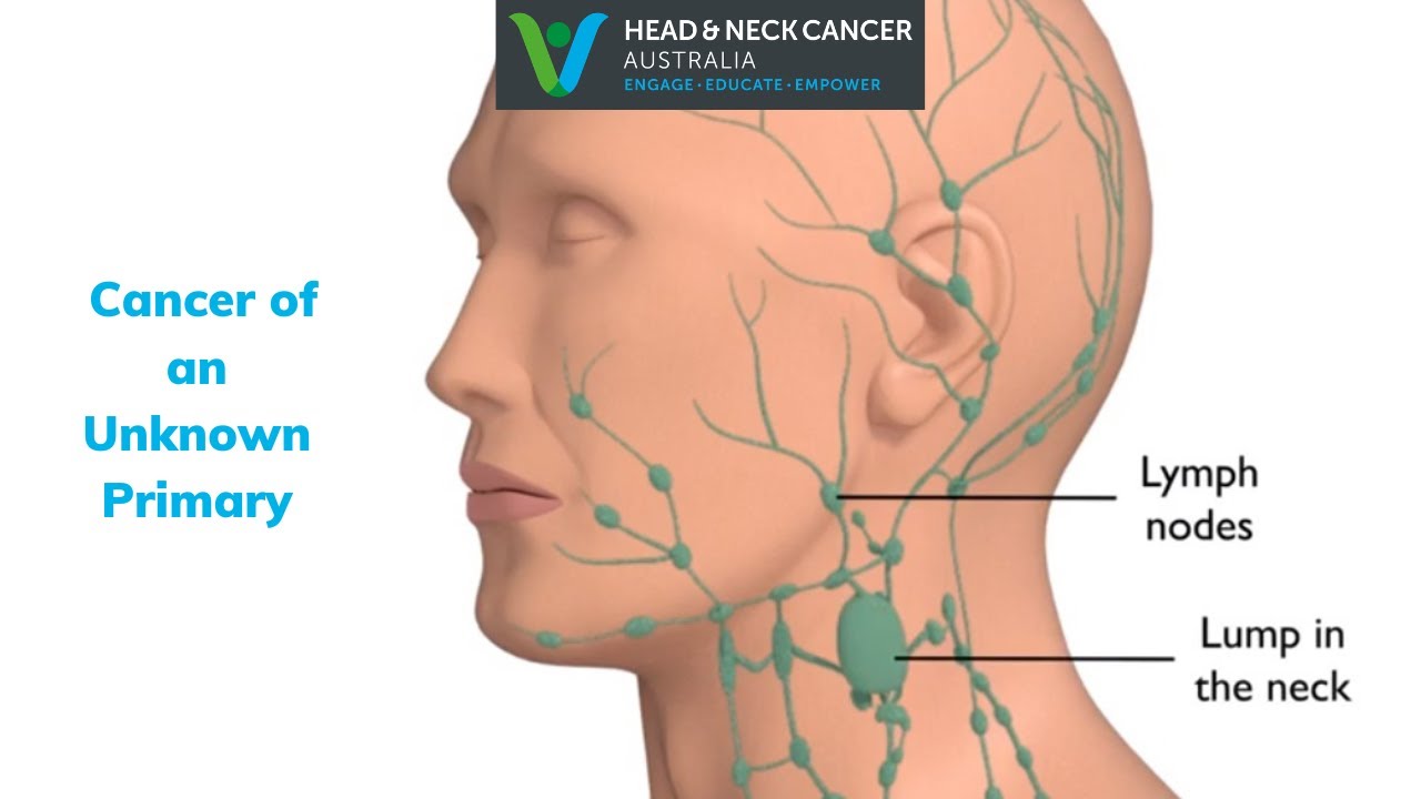 Unknown Primary Cancer - What Is It? What are the Symptoms and Treatment? Head and Neck Cancer