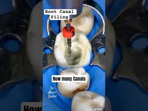Filing Root Canal Tooth