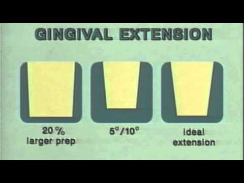 Gingival extension