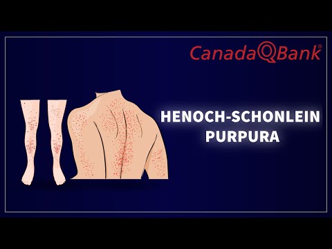 Henoch Schonlein Purpura
