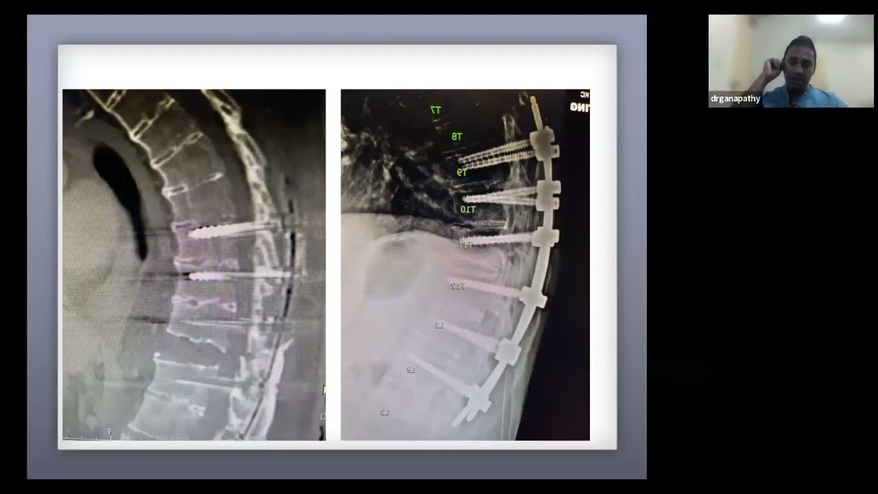 “Stoop to Conquer” Overview & Principles of Management of Ankylosing Spondylitis : V. Ganapathy, MD