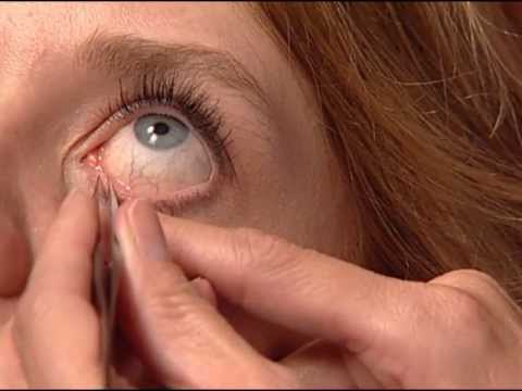 Odyssey Medical: Parasol Punctum Plug