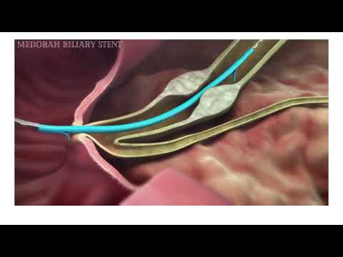 Surgical Stent at Best Price in India