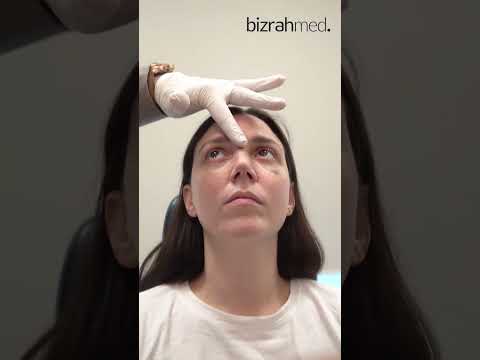 Transformation Unveiled: Before and After Rhinoplasty | Dr Bashar Bizrah/London/Dubai