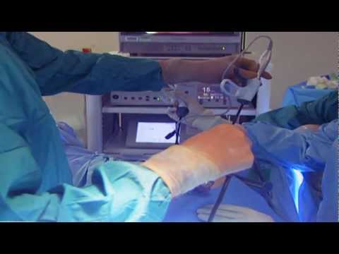 Laparoscopic Instruments - Laparoscopic Surgical Instruments Latest ...