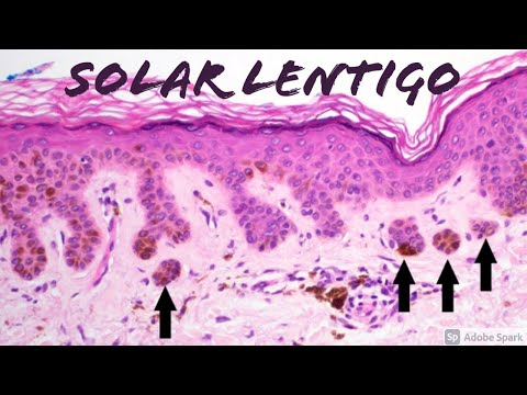 Solar Lentigo (vs Lentigo Maligna Melanoma In Situ on SOX-10 Stain): 5-Minute Pathology Pearls