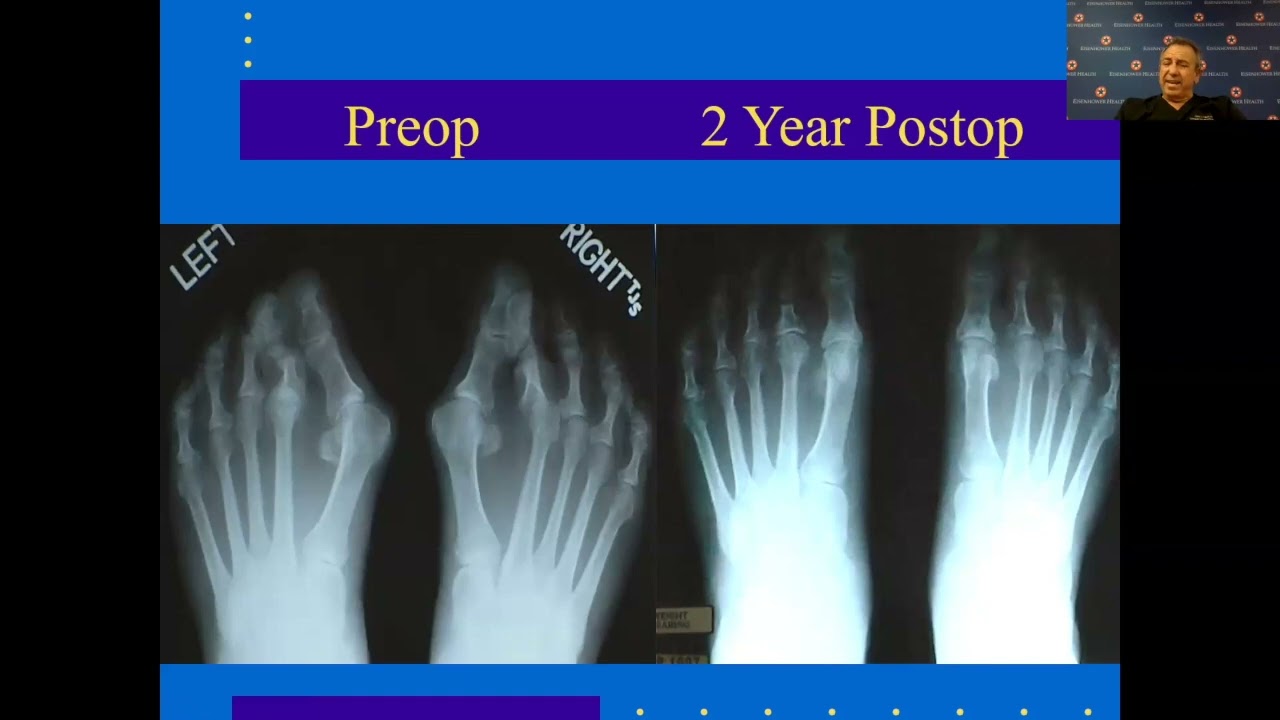 Bunions