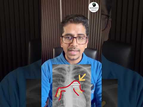 Guess the abnormalities in the Chest X-rays! #pulmonology #radiology #internalmedicine
