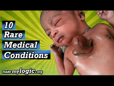 Top 10 Rare Diseases and Rare Disorders You Do Not know about