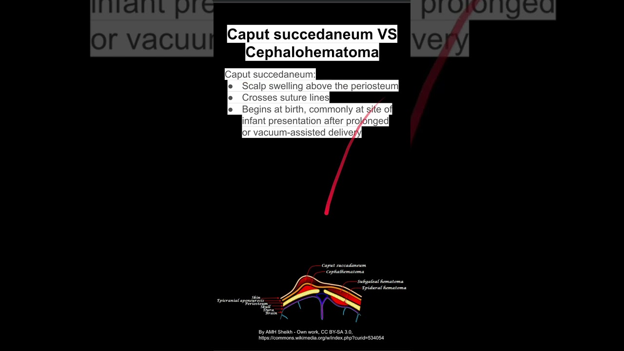 Caput succedaneum VS Cephalohematoma