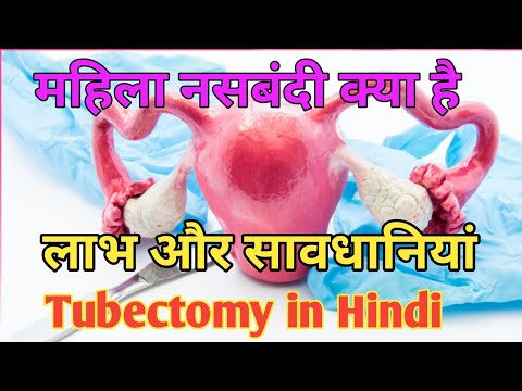 महिला नसबंदी // Tubectomy in hindi // Female vasectomy //Female sterilization method