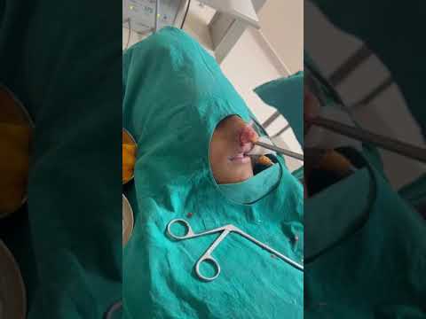Nasal Disorders and Treatment for Nasal Polyps