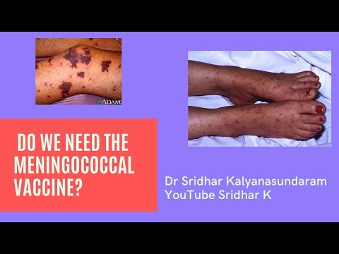 Meningococcal vaccine-do we need to give and when do we give it? Dr Sridhar Kalyanasundaram
