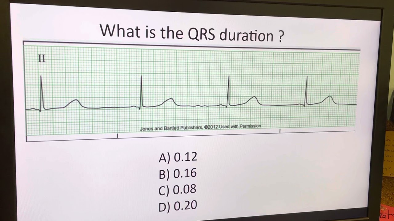 Telemetry Analysis: Video 2: Measuring the Duration of the QRS Complex
