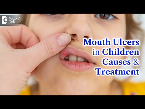 Mouth Ulcers in Children | MOUTH ULCER Treatment & Causes - Dr. K Saranya | Doctors' Circle