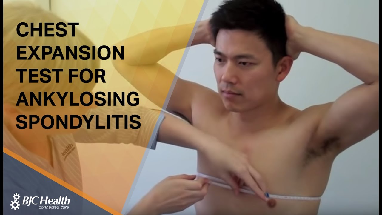 Chest Expansion Test for Ankylosing Spondylitis