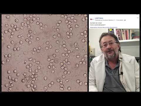 Leucocitúria Maciça | LAB Prática