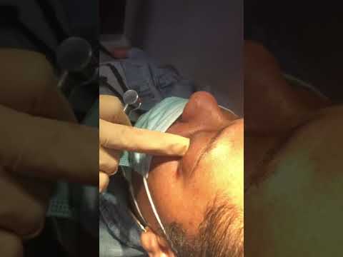 Post Chalazion removal part 4 #shorts #shortsfeed #shortvideo #eyes #asmr#youtubeshorts