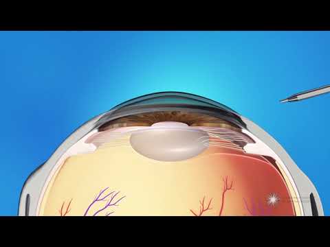 What is Refractive Lens Exchange Surgery?