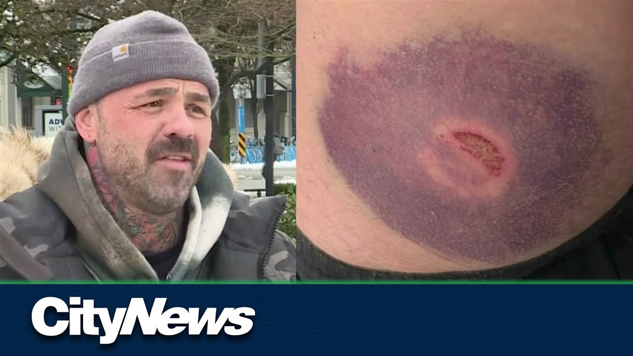 Man left with bruises after the Vancouver police mistakenly shot him with rubber bullets
