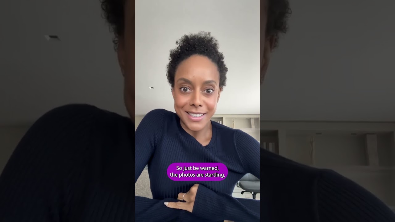 Victoria's Lupus Flare
