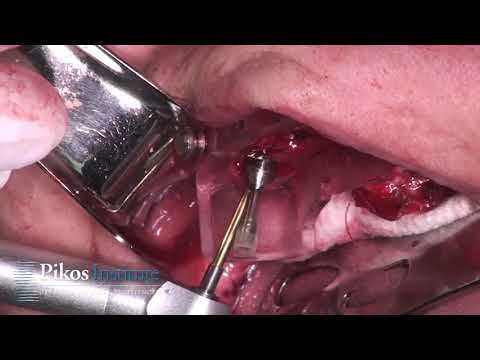 Preview Fully Guided Full Arch Immediate Implant Reconstruction Case with nSequence Prosthetic Proto